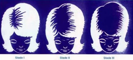 Hair loss and baldness medical diagnosis - Lausanne Geneva, Switzerland