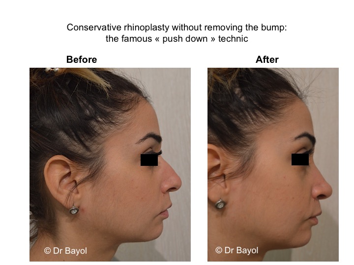 Rhinoplasty Switzerland : nose surgery in Geneva and Lausanne - Dr Bayol